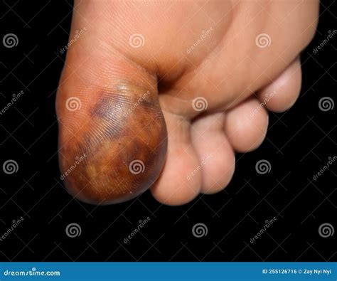 Abscess And Cellulitis Or Staphylococcal Streptococcal Skin Infection