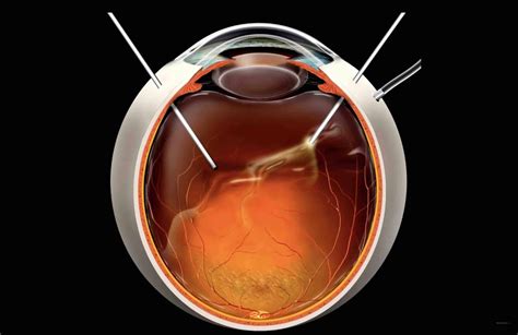Vitrectomy Top Of The Line Experience And Medical Equipment