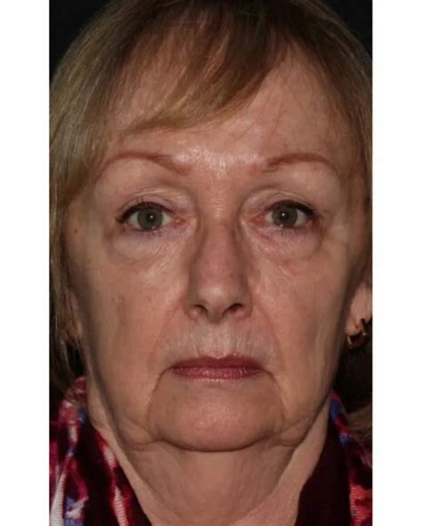 Non Surgical Face And Body Lifts With Pdo Threads Portland SantÉ