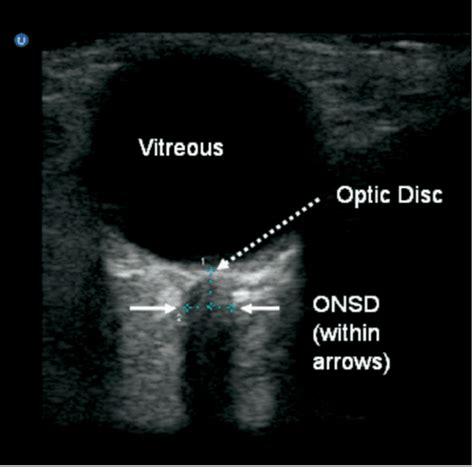 The Use Of Pocus Obtained Optic Nerve Sheath Diameter In Intracerebral Hemorrhage Pocus Journal