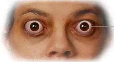 大眼睛的烦恼甲亢突眼患者从天津赴四川千里寻医获治疗 手机新浪网