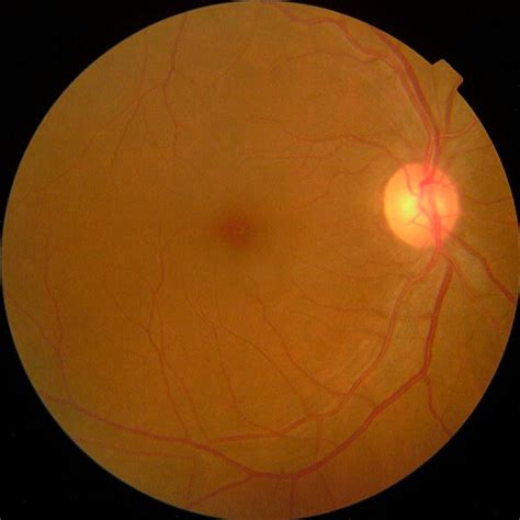 Optic Disc Detection Object Detection Dataset And Pre Trained Model By Opticdisc