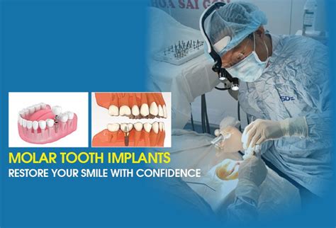 Molar Tooth Implants Restore Your Smile With Confidence Saigon