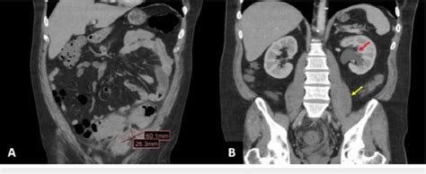 A Sigmoid Diverticulitis With Perisigmoid Abscess Measuring 6 Cm × Download Scientific