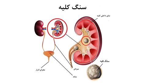 سریعترین و راحت ترین درمان سنگ کلیه فقط با نوشیدن آب