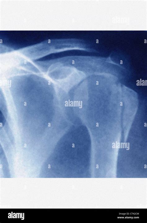 Left Shoulder X Ray Fracture At Jeremy Sanchez Blog
