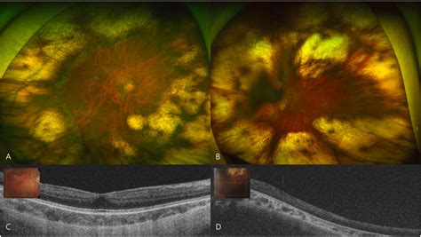 Ten Year Outcomes After Initial Management With Laser Photocoagulation Versus Intravitreal