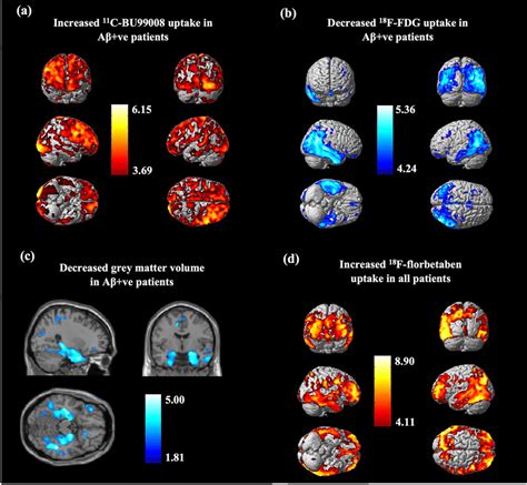 Statistical Parametric Mapping Spm Group Analysis In Patients