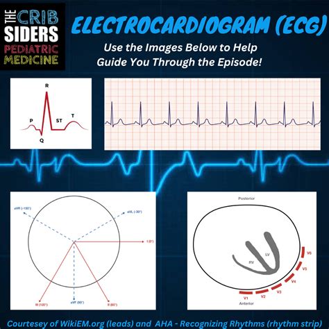 Hypocalcemia Ekg