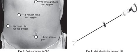 Laparoscopic Cholecystectomy Ports