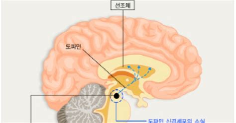 고령화의 그늘 퇴행성 뇌질환 파킨슨병 환자 지속 증가세