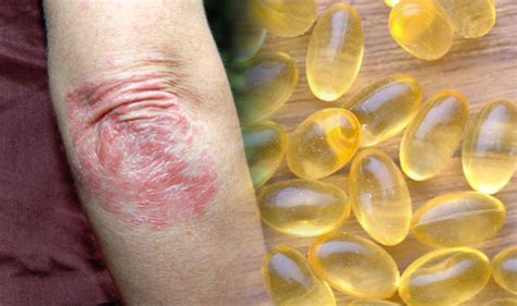 Best Supplements For Skin Omega 3 Can Help Relieve Symptoms Of Psoriasis Uk