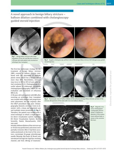 Pdf A Novel Approach In Benign Biliary Stricture Balloon Dilation Combined With