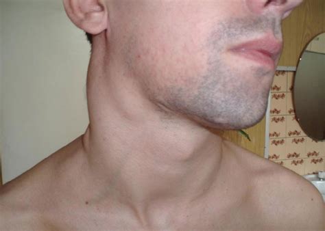 Как распознать рак на ранней стадии Первые признаки онкологии