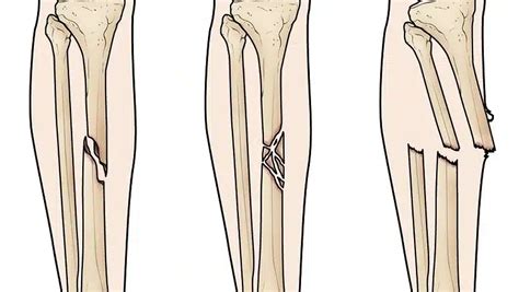 Tibia Fibula Shaft Teachme Orthopedics