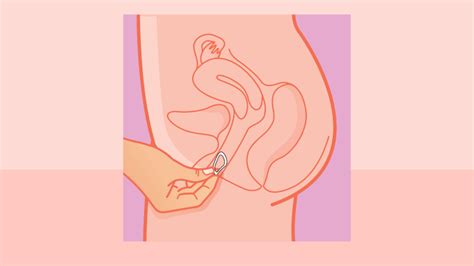 Annovera Vs NuvaRing Is A Vaginal Ring The Right Birth Control For