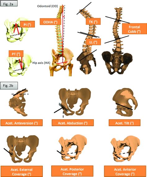 Radiographic Parameters Calculated On 3d Skeletal Reconstructions A