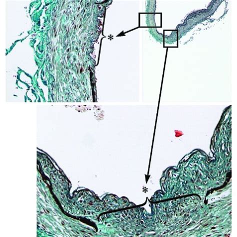 Photomicrographs Showing Defects Asterisks In The Internal Elastic Download Scientific