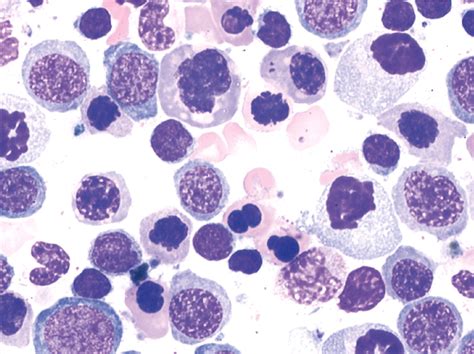 A New Type Of Transfusion Dependent Congenital Dyserythropoietic Anemia