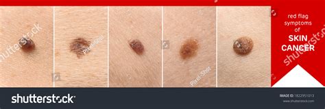 Types Of Moles Stock Photos Images Photography Shutterstock