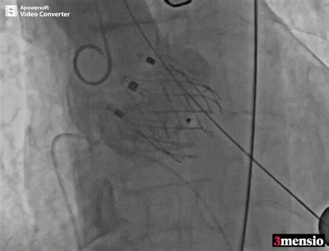 山东首例 齐鲁医院ken Valve确证性临床研究首例入组圆满成功 严道脑血管网