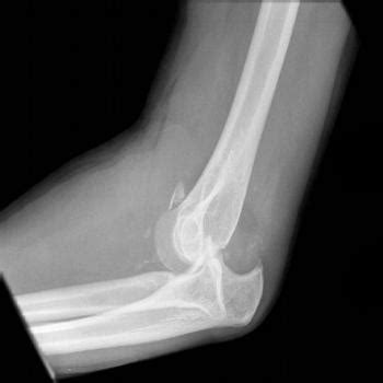 Bone Fracture Detection Object Detection Dataset V1 2023 03 05 5 51pm