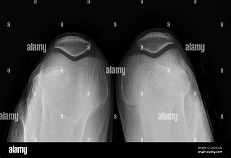 X Ray Image Of Both Patella Fracture For Diagnostic Patella Fracture Or Patella Dislocation
