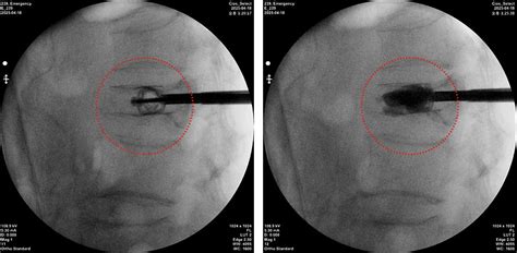 국제바로병원 척추 압박골절환자 신의료기술 티타늄임플란트 척추보강술 인천 최초 첫 성공