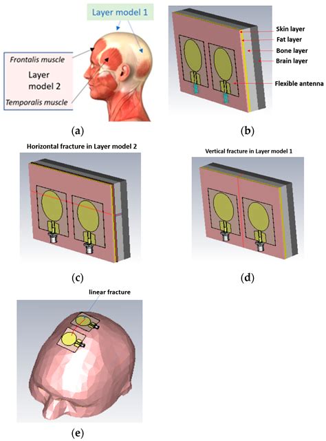 Microwave Technique For Linear Skull Fracture Detection—simulation And