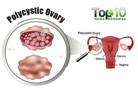 Home Remedies For Polycystic Ovary Syndrome Pcos Top 10 Home Remedies