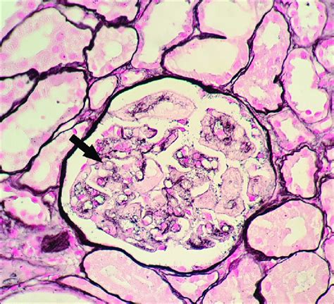 Capillary Loops Show Segmental Glomerular Basement Membrane Duplication Download Scientific