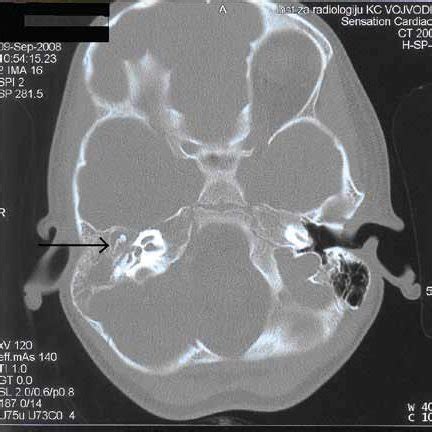 Temporal Bone Computed Tomography CT Scan Of A Patient Download Scientific Diagram