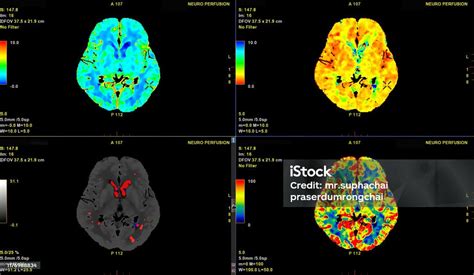 Ct Brain Perfusion Atau Ct Scan Image Dari Otak 3d Rendering Image Menganalisis Aliran Darah