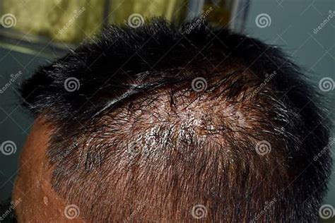 Seborrheic Dermatitis At The Scalp Of Southeast Asian Myanmar Adult