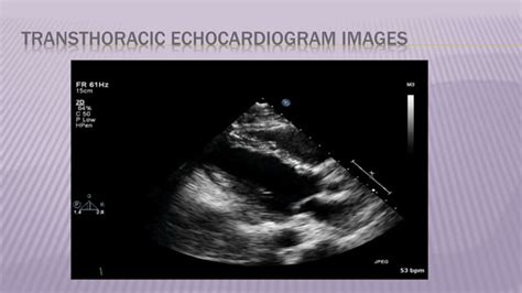 Subaortic Membrane Pptx Heart And Cardiovascular Diseases Diseases And Conditions
