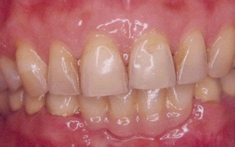 Dentures Partial Fixed And Flexible Dentures Cost Full Dentures