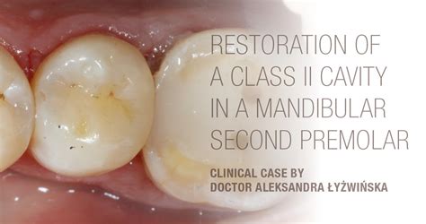 Clinical Case Restoration Of A Class Ii Cavity In A Mandibular Second