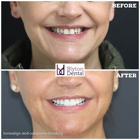 Invisalign And Composite Bonding — Blyton Dental