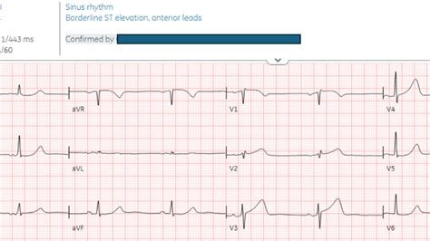 Dr Smiths Ecg Blog Page 2 Of 194 Expert Ecg Interpretation And Emergency Cardiology Education