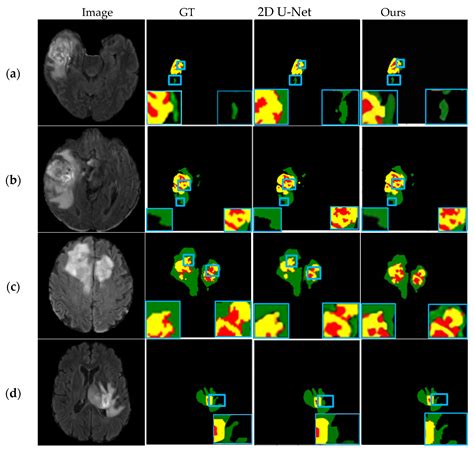 Applied Sciences Free Full Text A Multi Brain Tumor Region Segmentation Model Based On 3d U Net