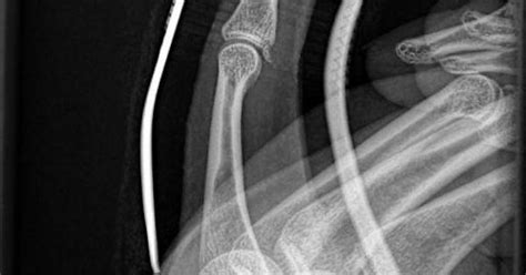 3 Weeks Post Fracture Album On Imgur