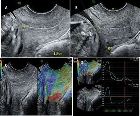 Patient 1—transvaginal Ultrasound Was Done Cervical Length