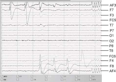 Eeg Signal Registered During Simultaneous Left And Right Eye Blinking