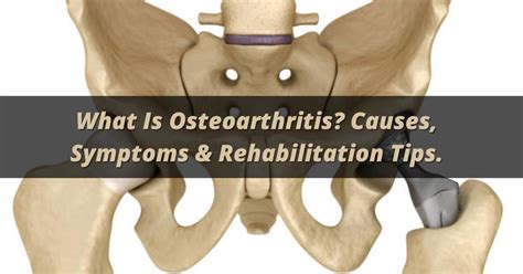 What Is Osteoarthritis Causes Symptoms And Rehabilitation Tips