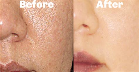 Get Rid Of Large Pores In 4 Steps Naturally Glowpink