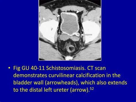 40 Bladder Masses On Computed Tomography And Magnetic Ppt