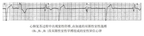 图室性逸搏和逸搏心律 心血管 医学名词 39疾病百科