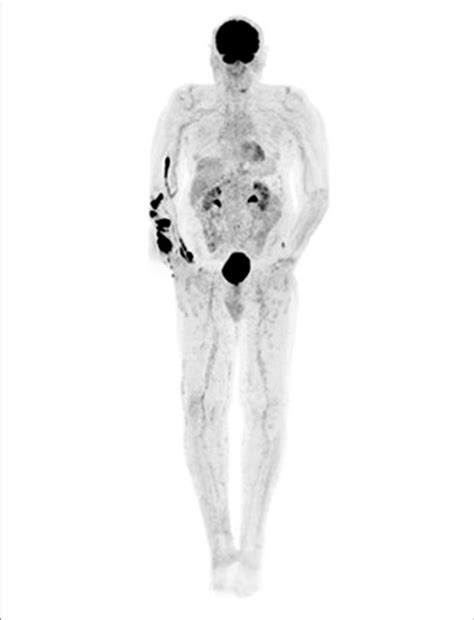 Mip Image Showing Tracer Extravasation Following Multiple Injection Download Scientific