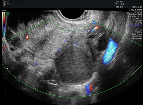 Transvaginal Ultrasound Endometriosis Bowel Endometriosis Ultrasound
