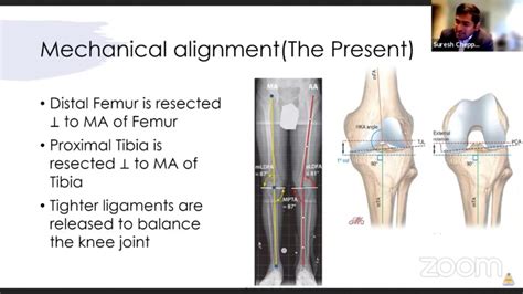 Alignment Options In Total Knee Replacement —